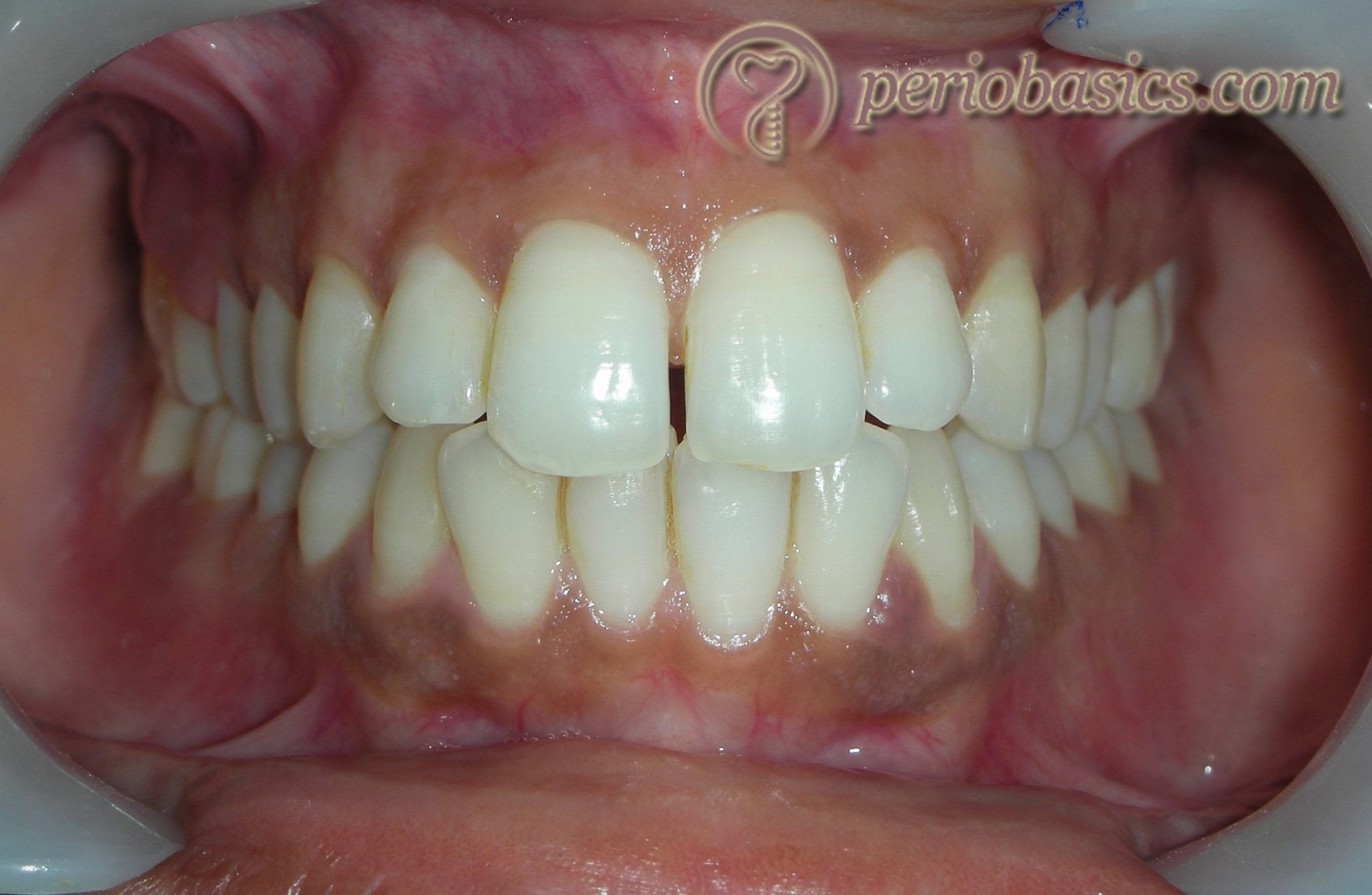 Gingival health, normal periodontium, Gingival color, contour, consistency.