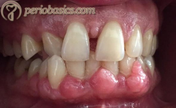 Gingival health, normal periodontium, Gingival color, contour, consistency.