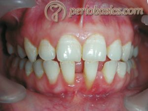 Dental calculus and its role in etiopathogenesis of periodontal diseases