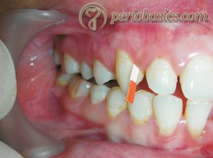 Gingival crevicular fluid and saliva in periodontal health and disease ...