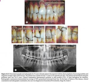 Periodontitis: Clinical presentation, diagnostic criteria and treatment ...