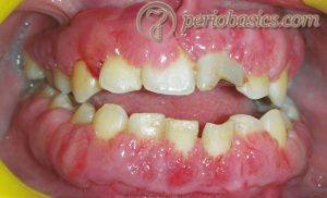 Gingival enlargement - periobasics.com Clinical Periodontology