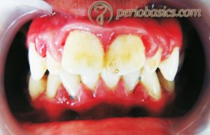 Gingivitis and its clinical features; periobasics.com