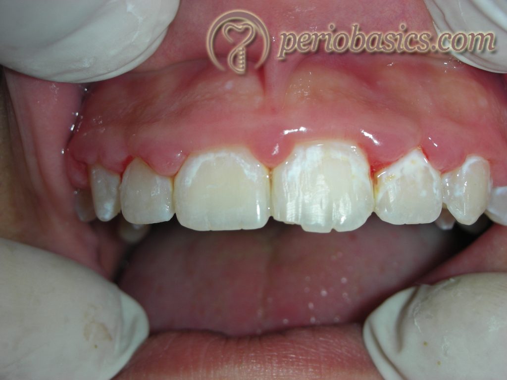 Gingival Enlargement Periobasics Clinical Periodontology Gingival Enlargement Periobasics Clinical Periodontology