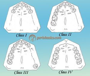 Bone considerations in dental implant therapy – periobasics.com