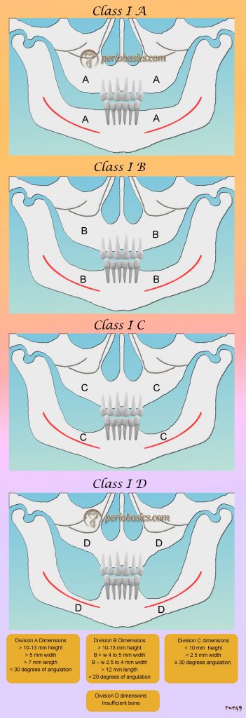 Bone considerations in dental implant therapy – periobasics.com