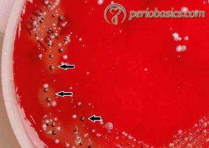 Role of Porphyromonas gingivalis in pathogenesis of periodontitis ...