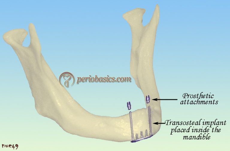 Historical aspect of dental implants - periobasics.com Implantology