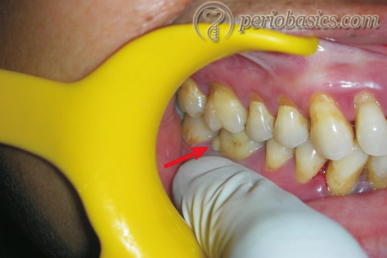 Periodontal abscess and its treatment – periobasics.com