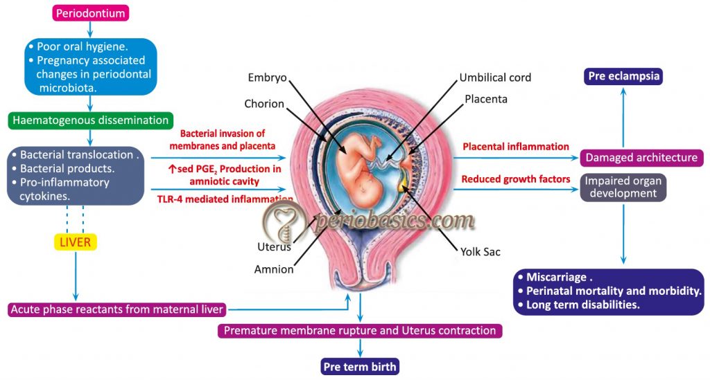 Adverse effects of periodontitis on pregnancy outcomes - periobasics.com