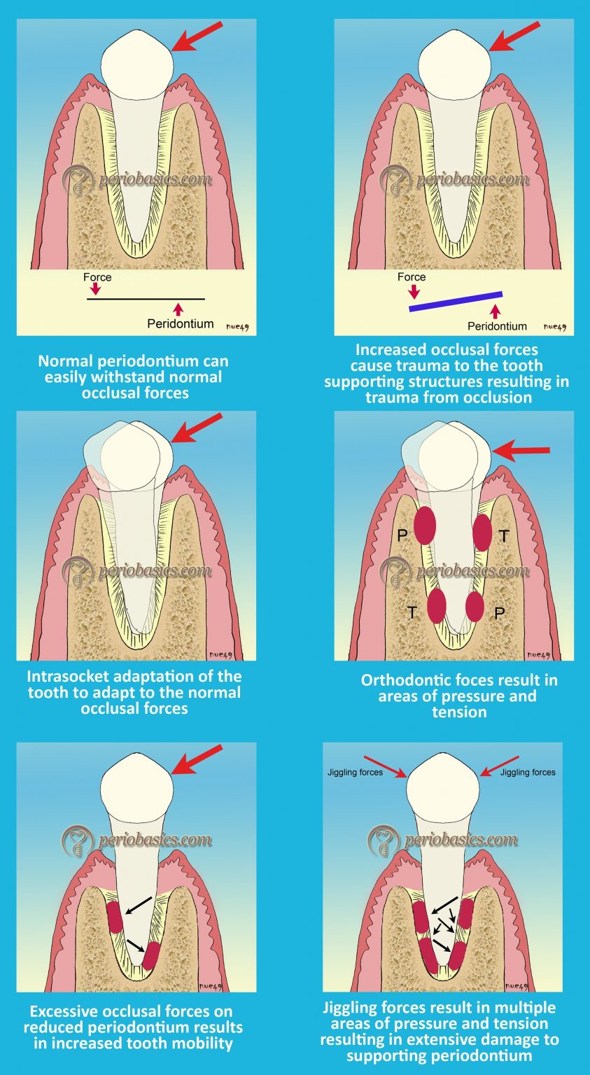 Trauma from occlusion - periobasics.com