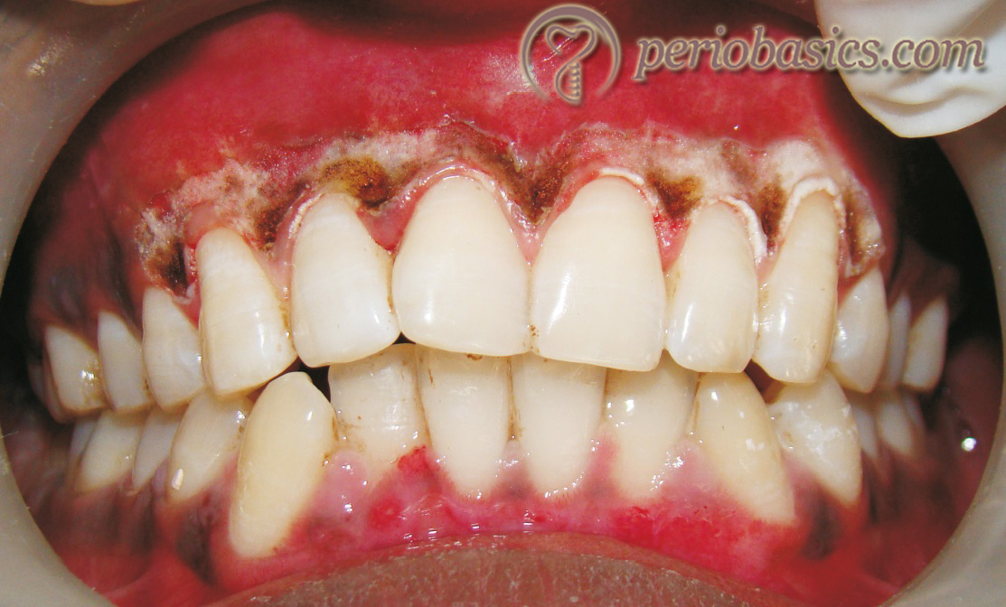 Lasers in periodontics - periobasics.com