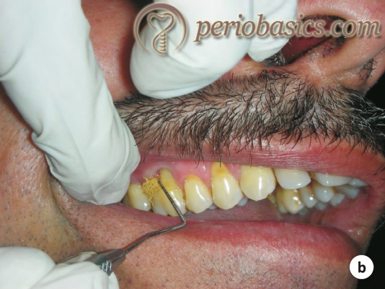 Local drug delivery in periodontics - periobasics.com