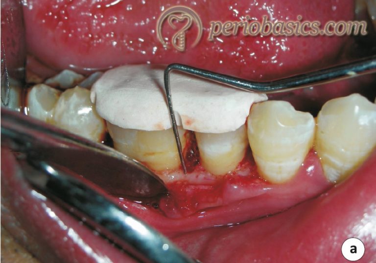Advanced diagnostic techniques in periodontics - periobasics.com