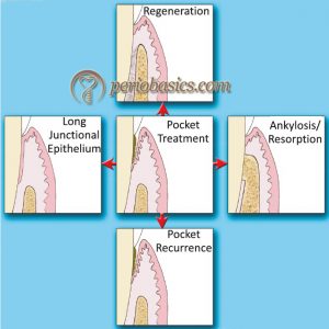 Rationale for periodontal treatment - periobasics.com