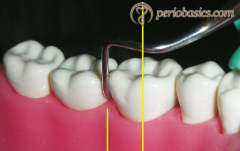 Principles of scaling and root planing – periobasics.com