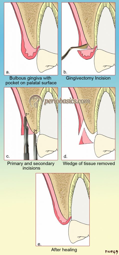 History of surgical periodontal pocket therapy and osseous resective ...