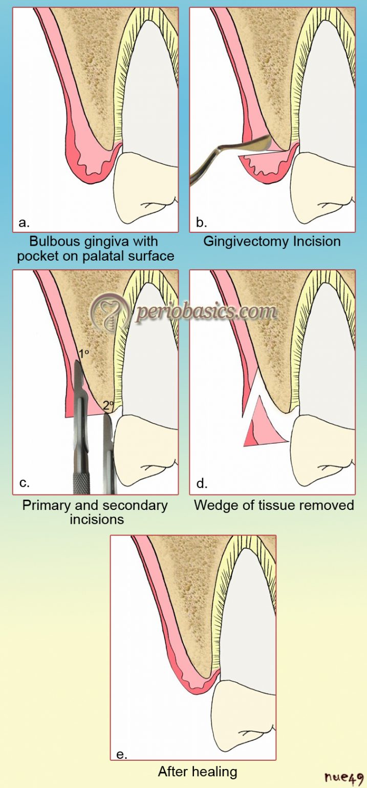 History of surgical periodontal pocket therapy and osseous resective ...