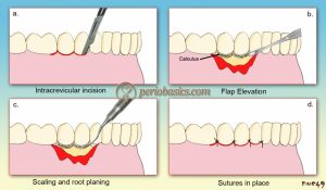 History of surgical periodontal pocket therapy and osseous resective ...