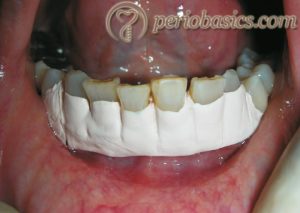 Periodontal dressing - periobasics.com